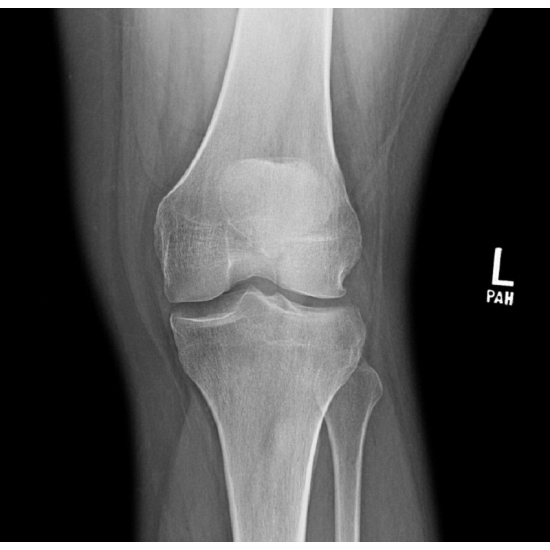 Left Medial Knee Pain