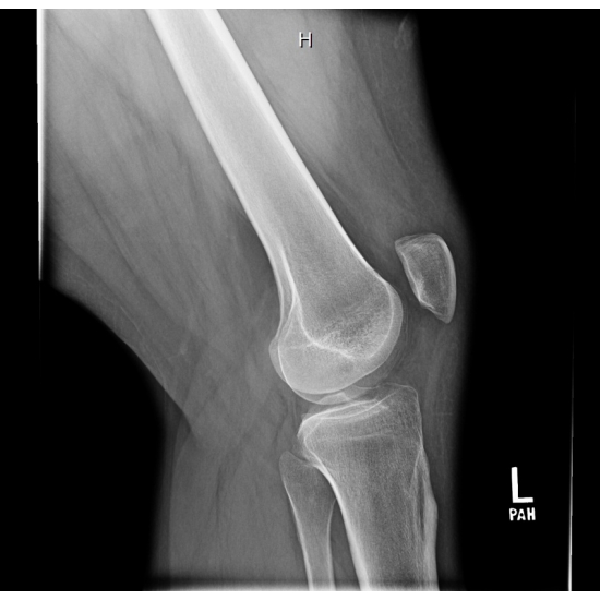 Left Medial Knee Pain