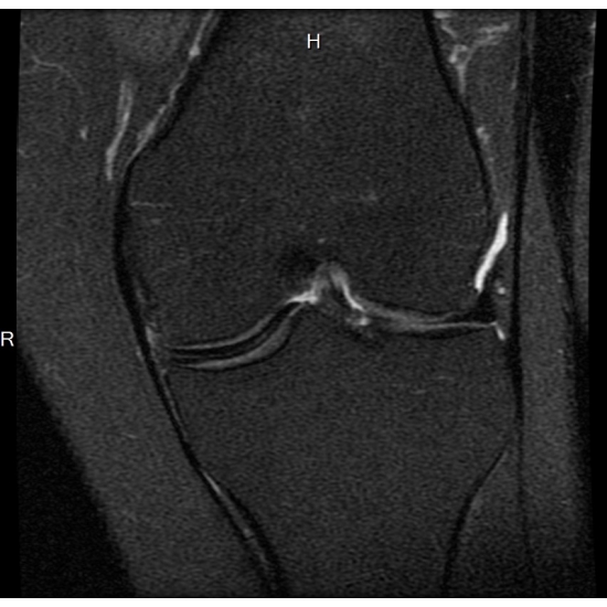 Left Medial Knee Pain